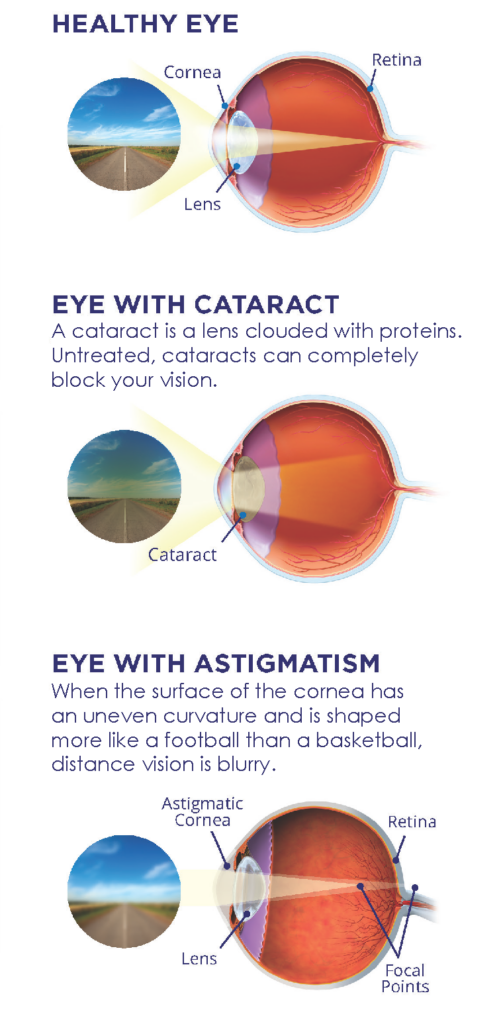 Cataract Care